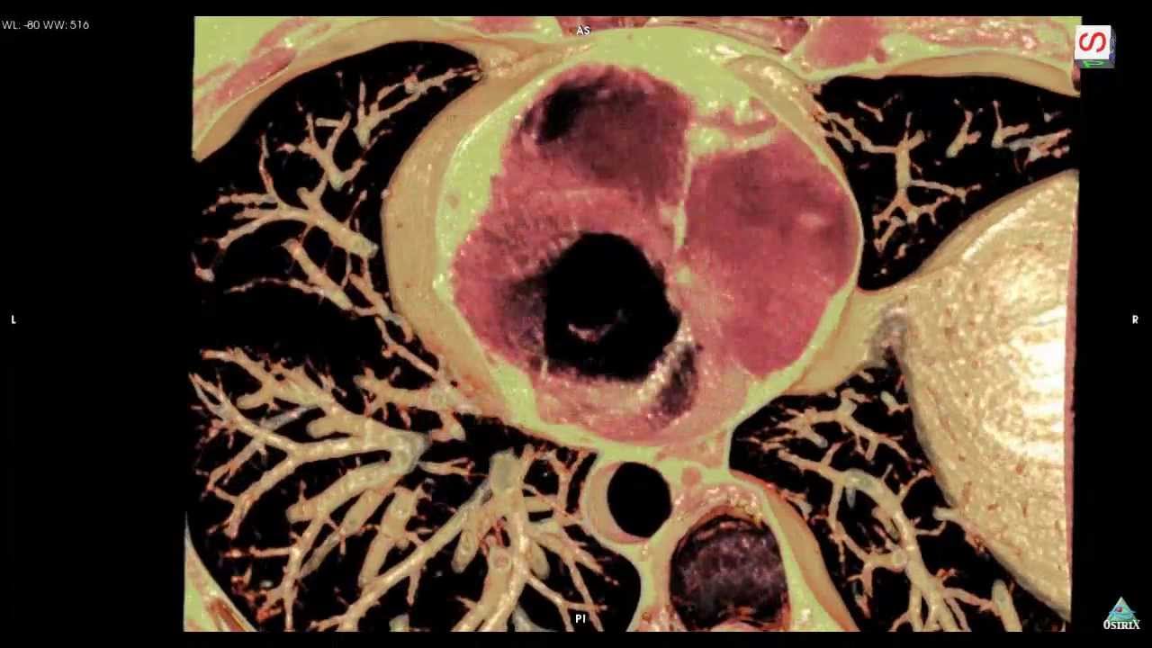 Thin slab volume rendering of beating heart wall motion - YouTube