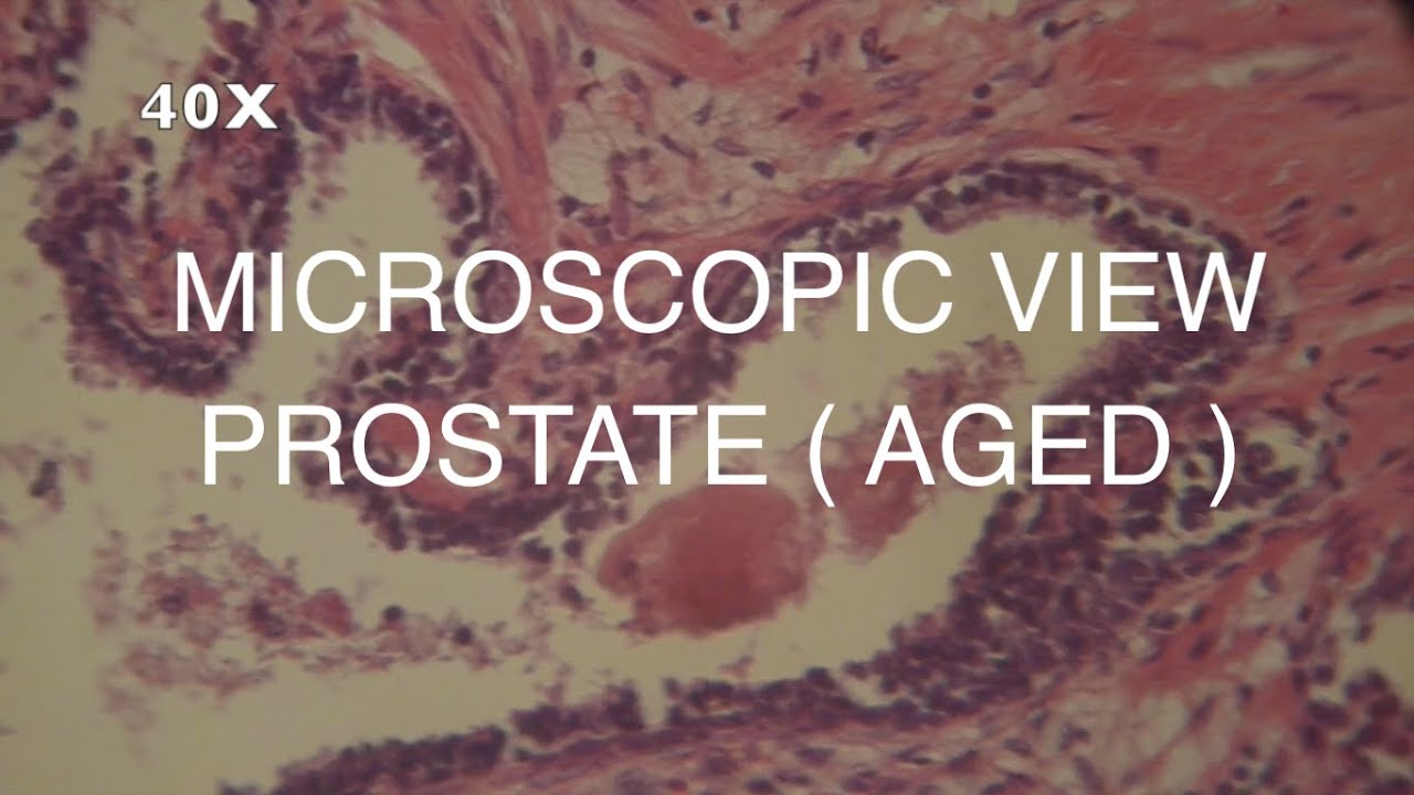 MICROSCOPIC VIEW - PROSTATE (AGED) - YouTube