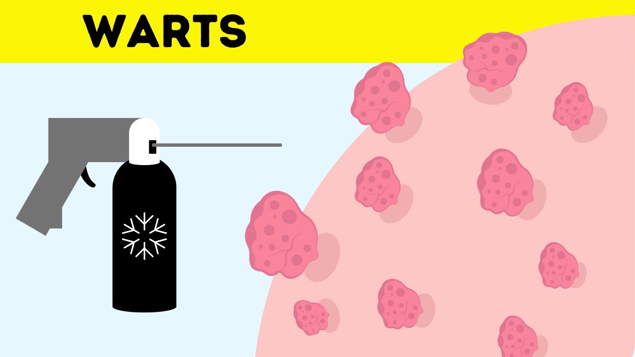 Warts - Different Types, Causes, Signs & Symptoms, And Treatment - YouTube