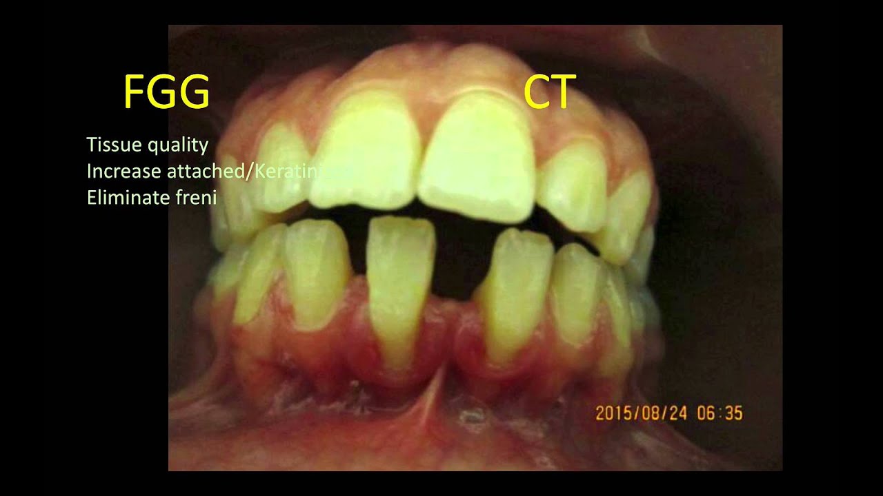 Recession on lower incisors. FGG or CT? (PART 2) - YouTube