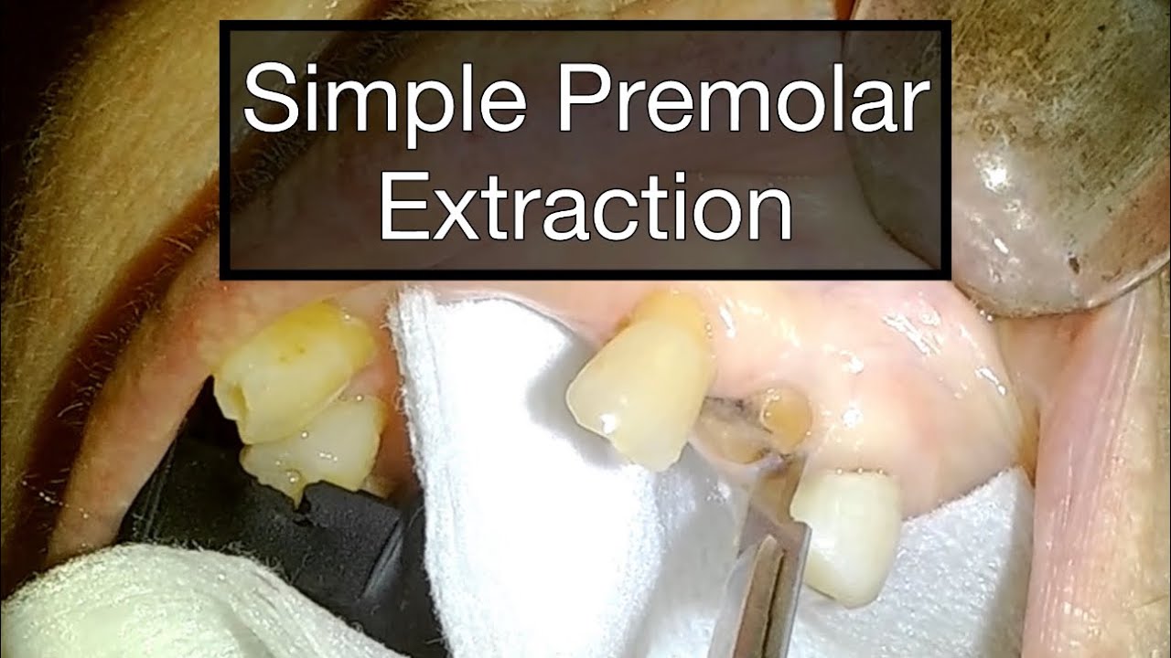 Simple Premolar Extraction Using the 15 Blade as my First Elevator ...
