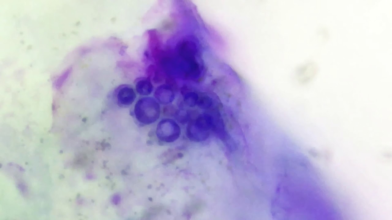 Cryptococcal spores in cytology - YouTube