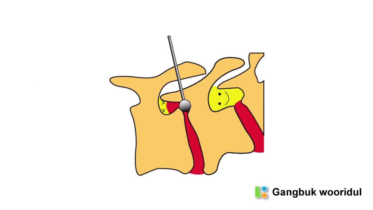 Easy spinal surgery :Lumbar extraforaminal decompression - YouTube