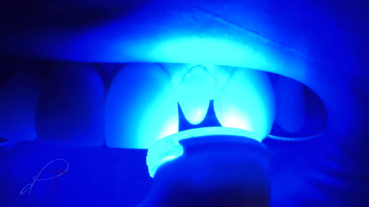 Fundamental Concepts for Restoring the Intraradicular Space PART 3 ...