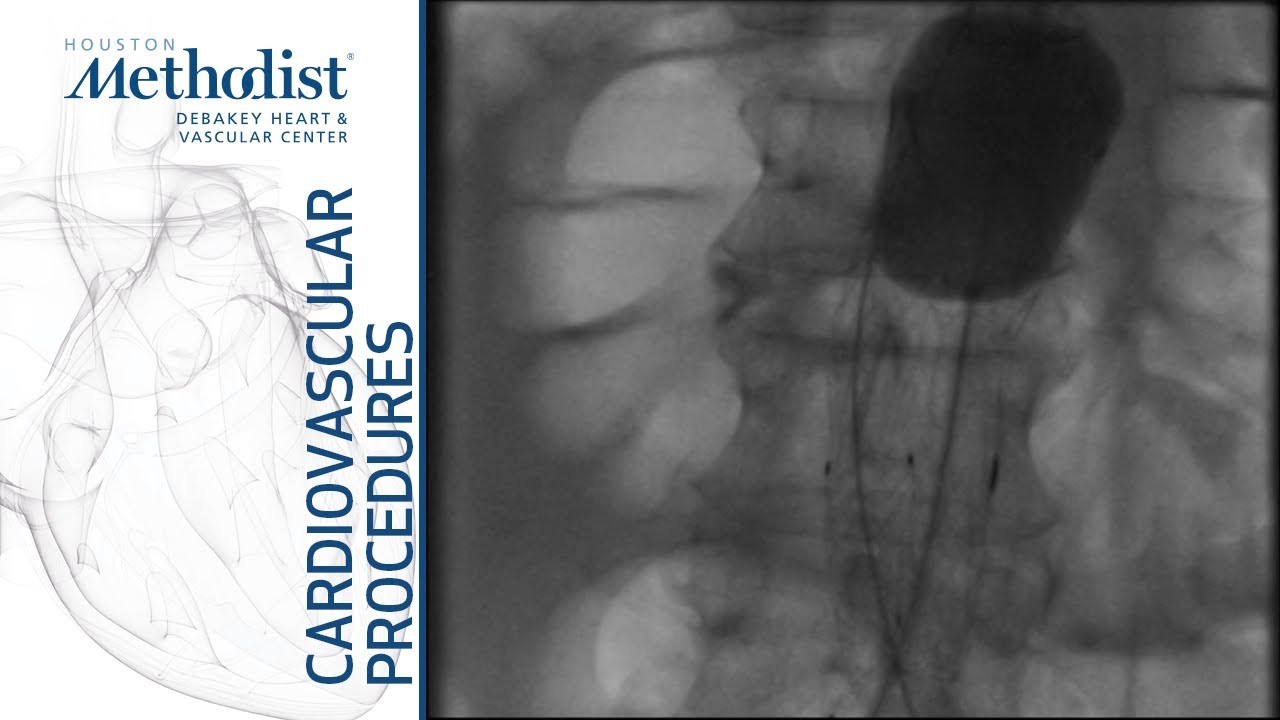 Endovascular Aortic Septotomy (Jean Bismuth, MD, Manuel Rojo, MD, M ...