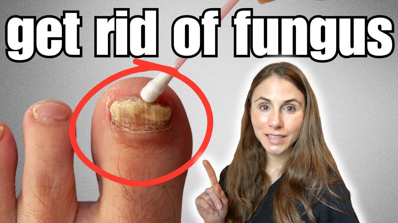 Get Rid Of Toenail Fungus With These 4 Easy Home Remedies - YouTube