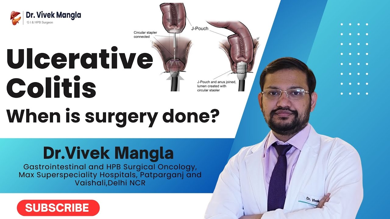 Surgery for Ulcerative Colitis: When, Why and Benefits - YouTube