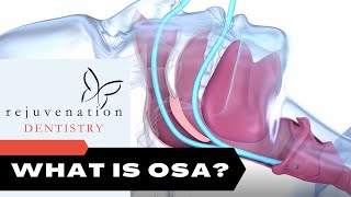 What Is Obstructive Sleep Apnea (OSA) And What Are The ... | Doovi