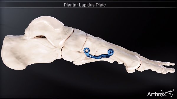 Plantar Lapidus Plate - YouTube