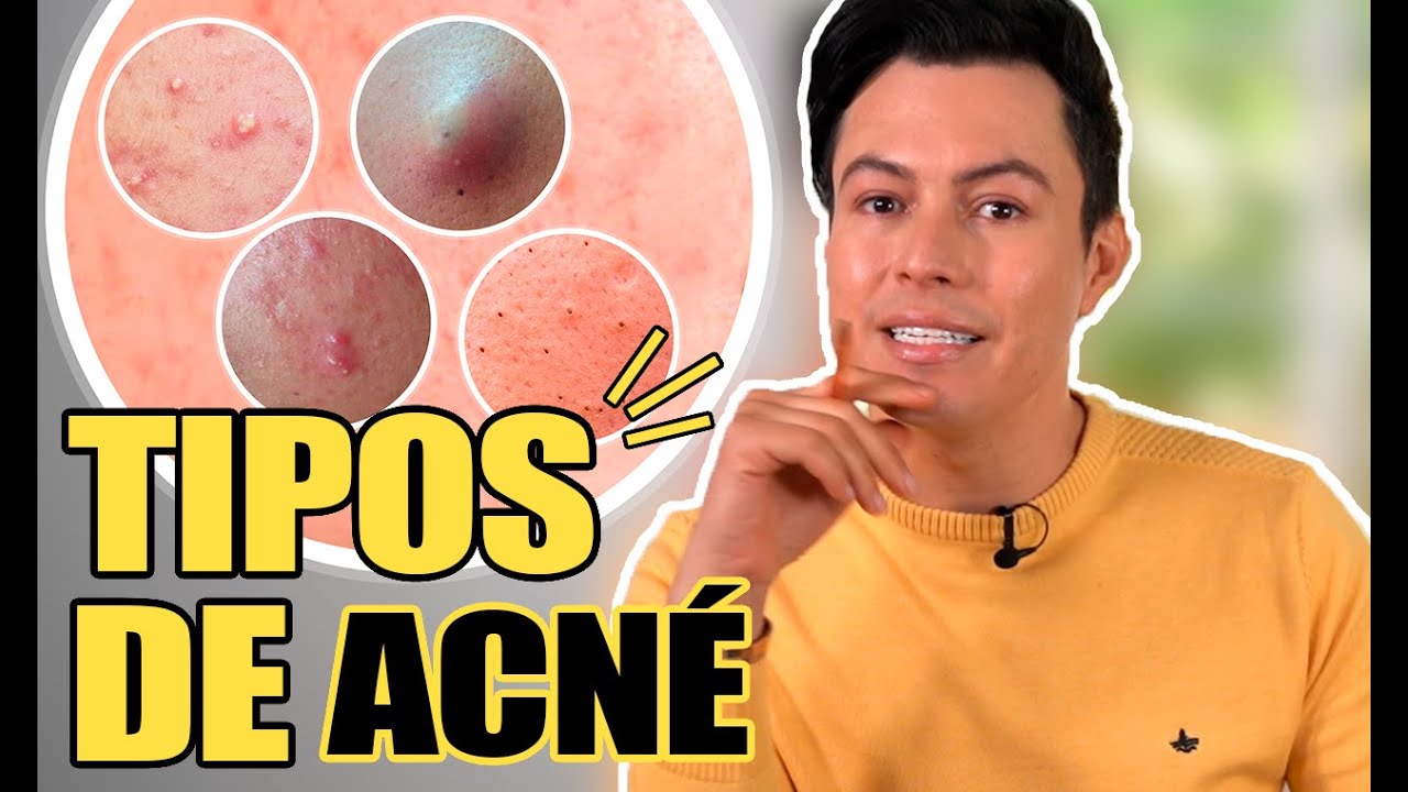 El acné: tipos y tratamiento adecuado