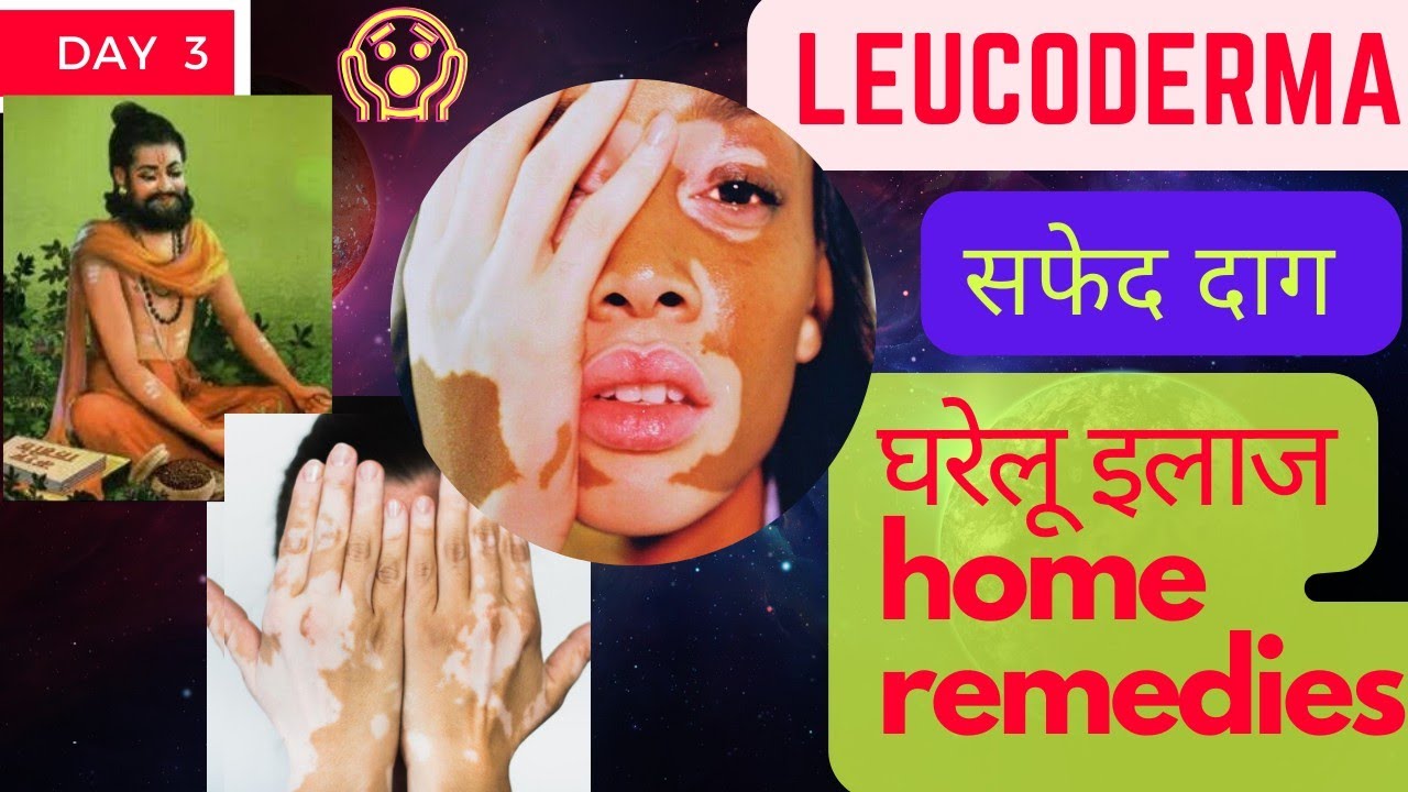 सफेद दाग के घरेलू इलाज white spots home remedies | safed daag thik kre ...