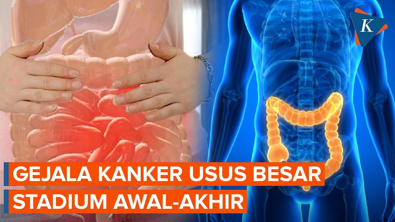 Kenali Tanda-tanda Kanker Usus Besar dari Stadium Awal hingga Akhir ...