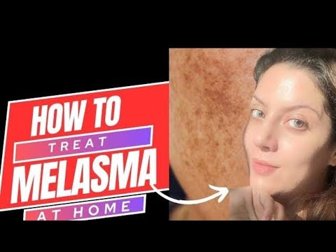 How to remove Melasma at home // Melasma treatment at home only 30 days ...