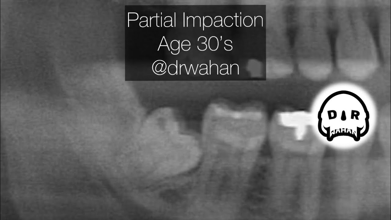 Mesioangular Wisdom Tooth Extraction @drwahan - YouTube