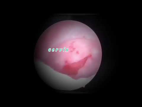 Vaginoscopy
