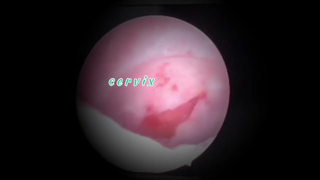 Vaginoscopy - YouTube