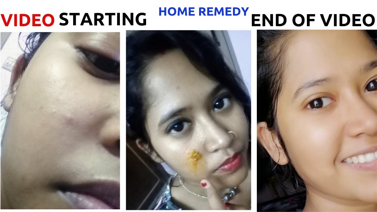 How to Remove Pimple/Muhase | Overnight | Home Remedy | 100% Result ...