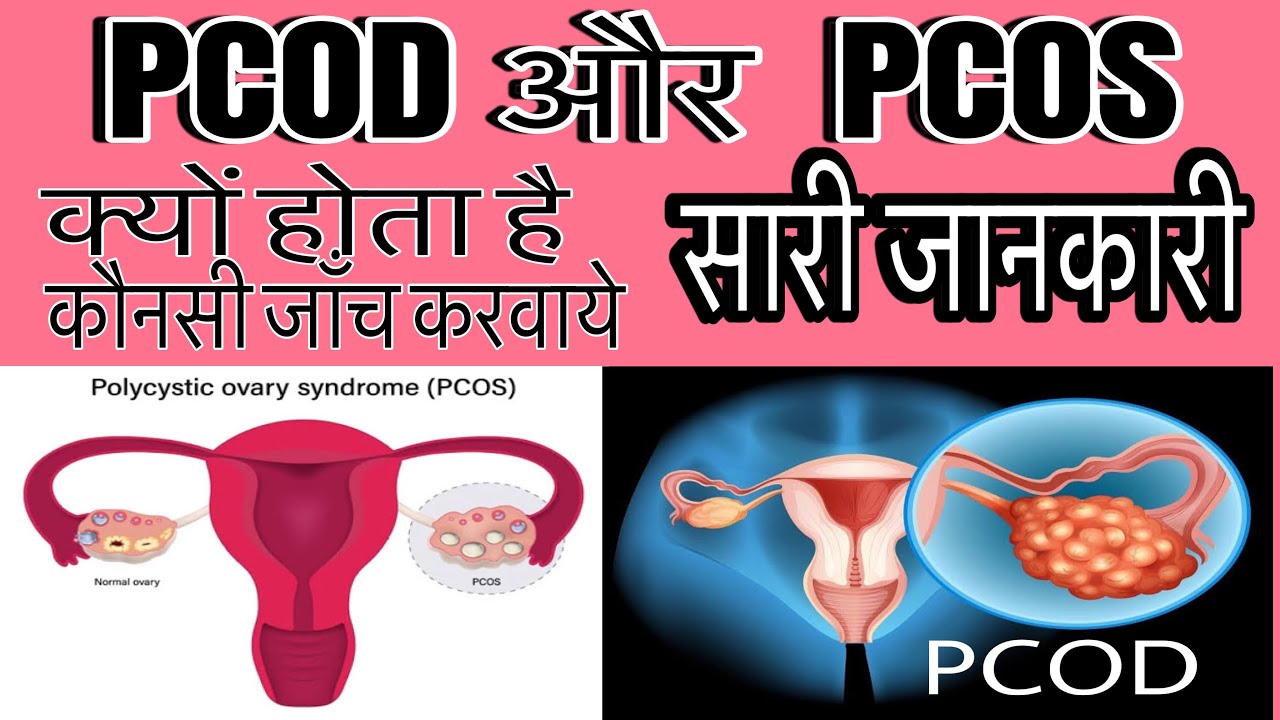 PCOD aur PCOS क्या होता हैं।Complete information of PCOD & PCOS| Female ...