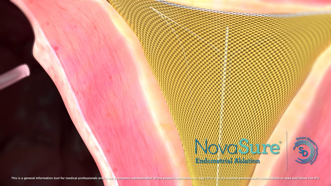 Animated Clip: The NovaSure procedure animation featuring SmartDepth ...