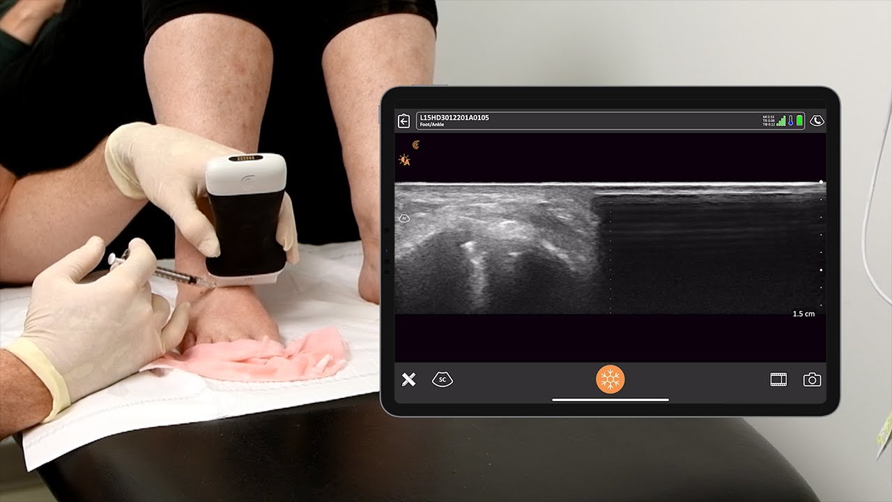 Cortisone Injections in the Foot - YouTube