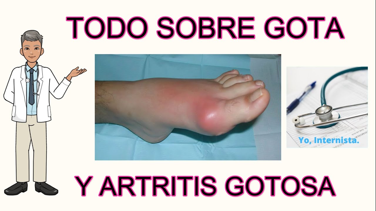 GOTA Y ARTRITIS GOTOSA PARA EL PACIENTE - YouTube