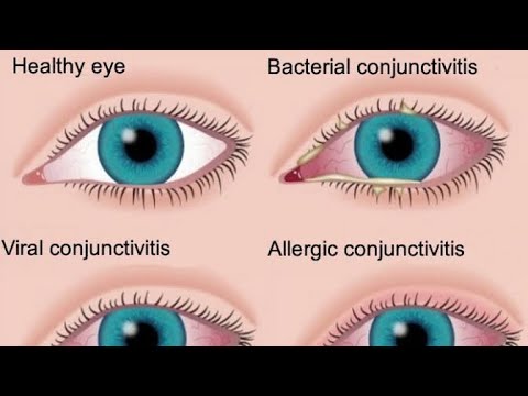 Conjunctivitis ||Full HD||कंजंक्टिवाइटिस (आँख आना) (या गुलाबी आंख ...
