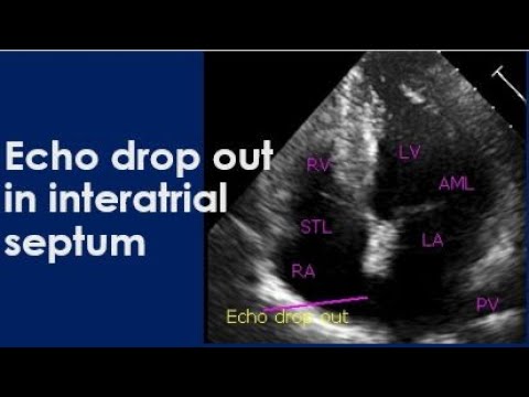 Echo drop out in interatrial septum - YouTube