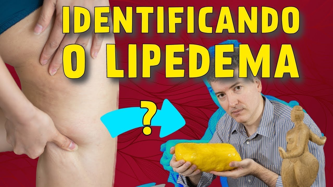 Como é Realizada a Identificação do Lipedema? - YouTube