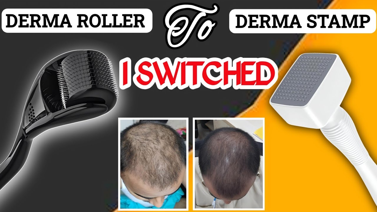 Derma Roller Vs Derma Stamp | Which is better for hair regrowth - YouTube