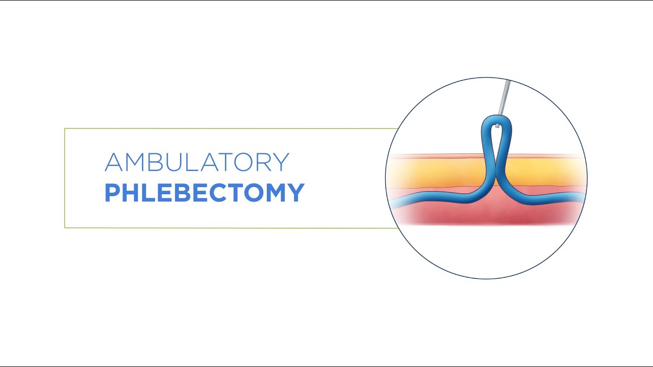 Varicose Vein Treatment - Ambulatory Phlebectomy - YouTube