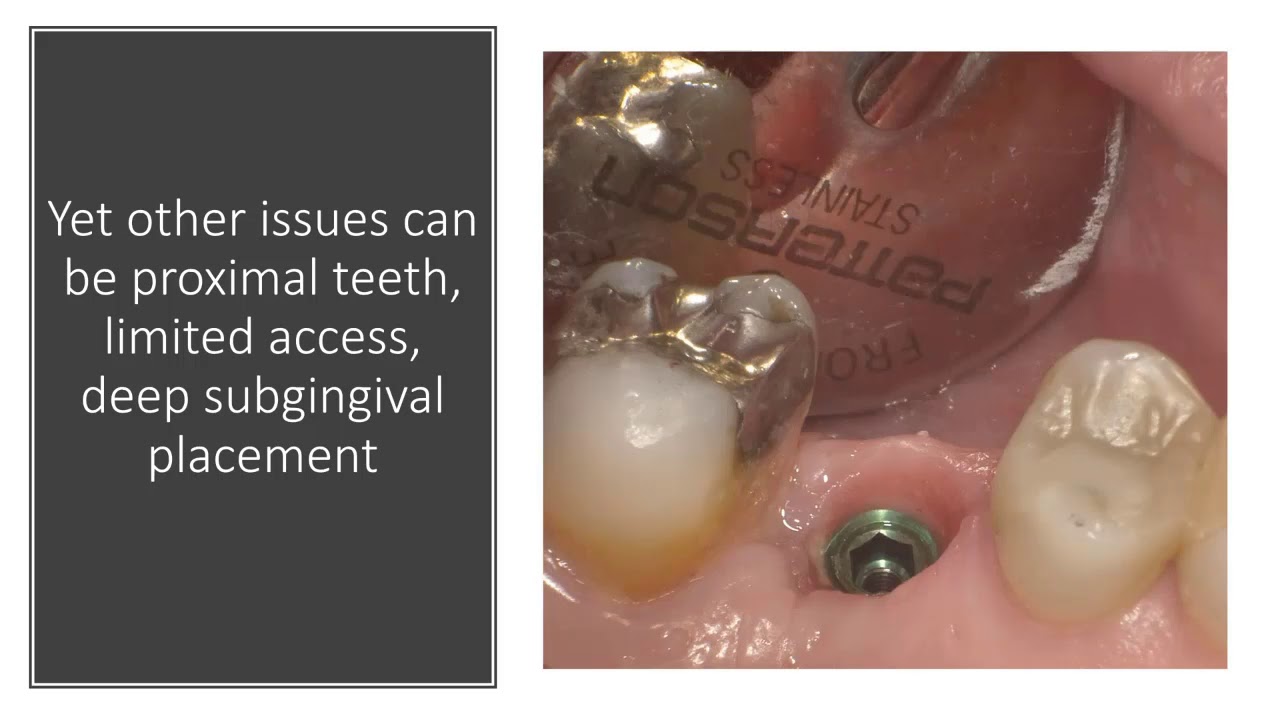 Dental Treatment: Implant Single Unit Sep 11, 2018 - YouTube