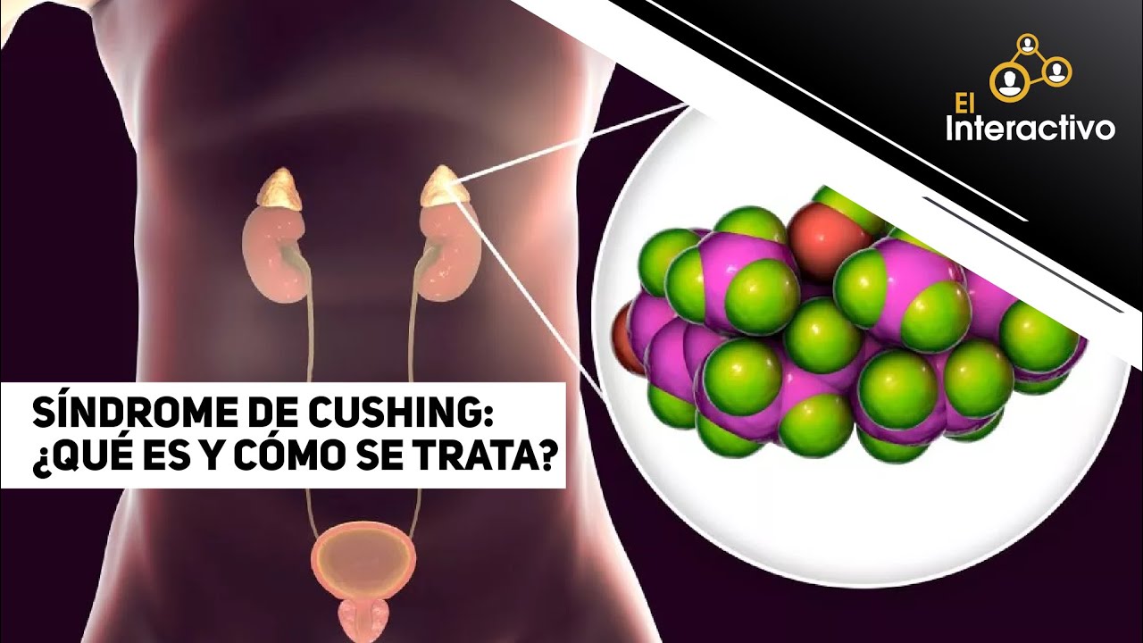 Síndrome de Cushing: qué es, cómo se diagnostica y cómo se trata - YouTube