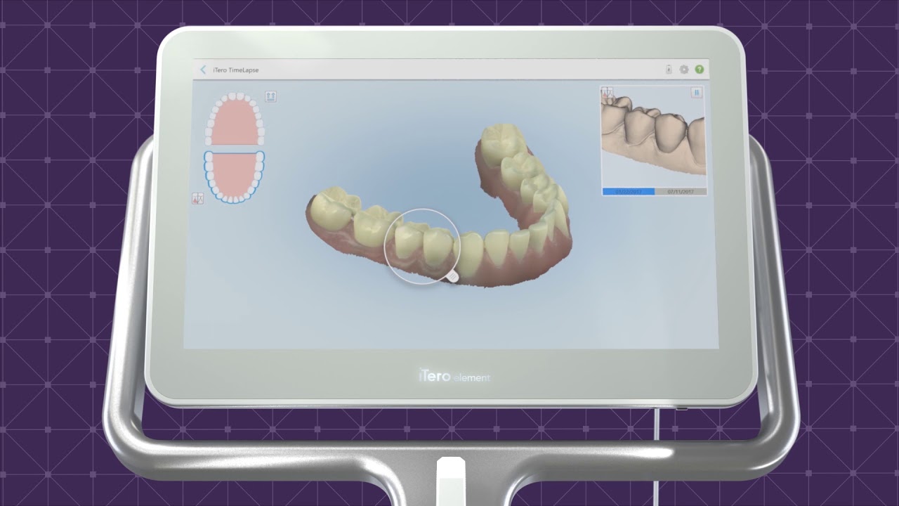 iTero Element® 2: Your Intuitive Digital Solution - YouTube