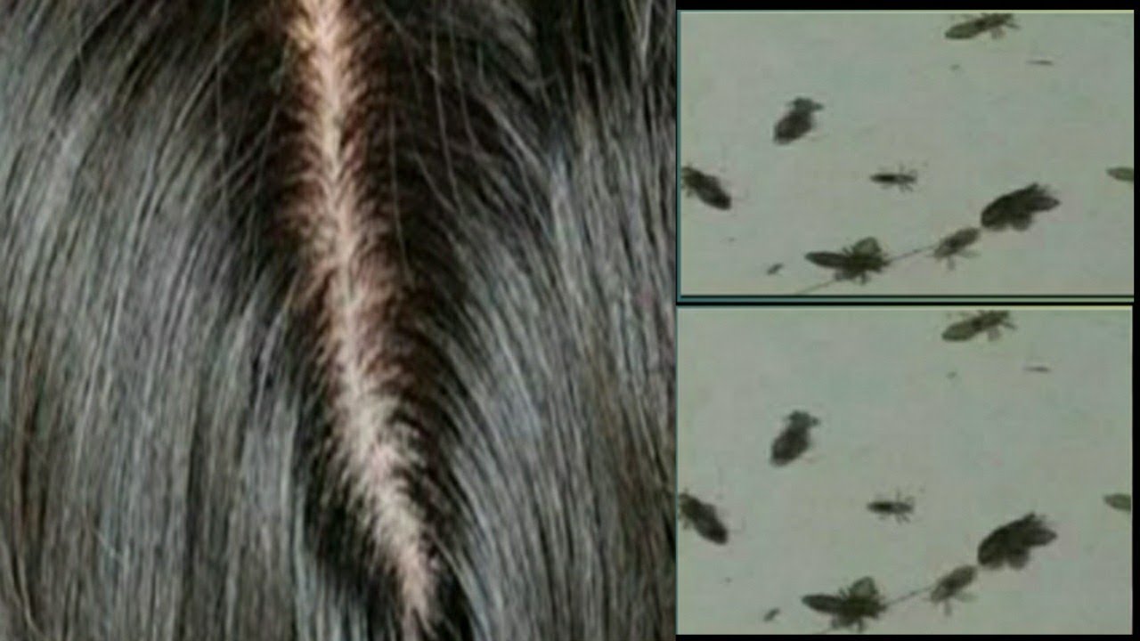 Lice &Nit picking in oiled Hair/ Traditional lice &Nit Picking/Hair ...