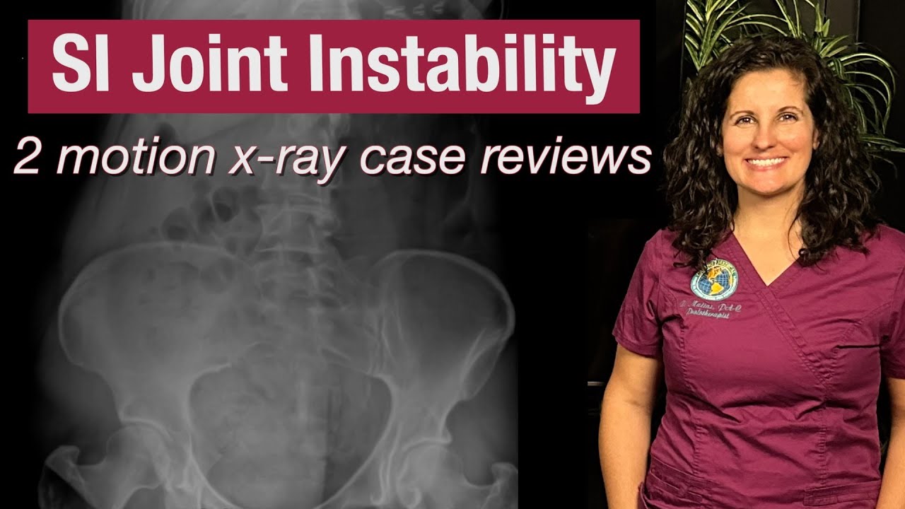 Sacroiliac joint instability seen on motion x-ray- 2 case reviews - YouTube