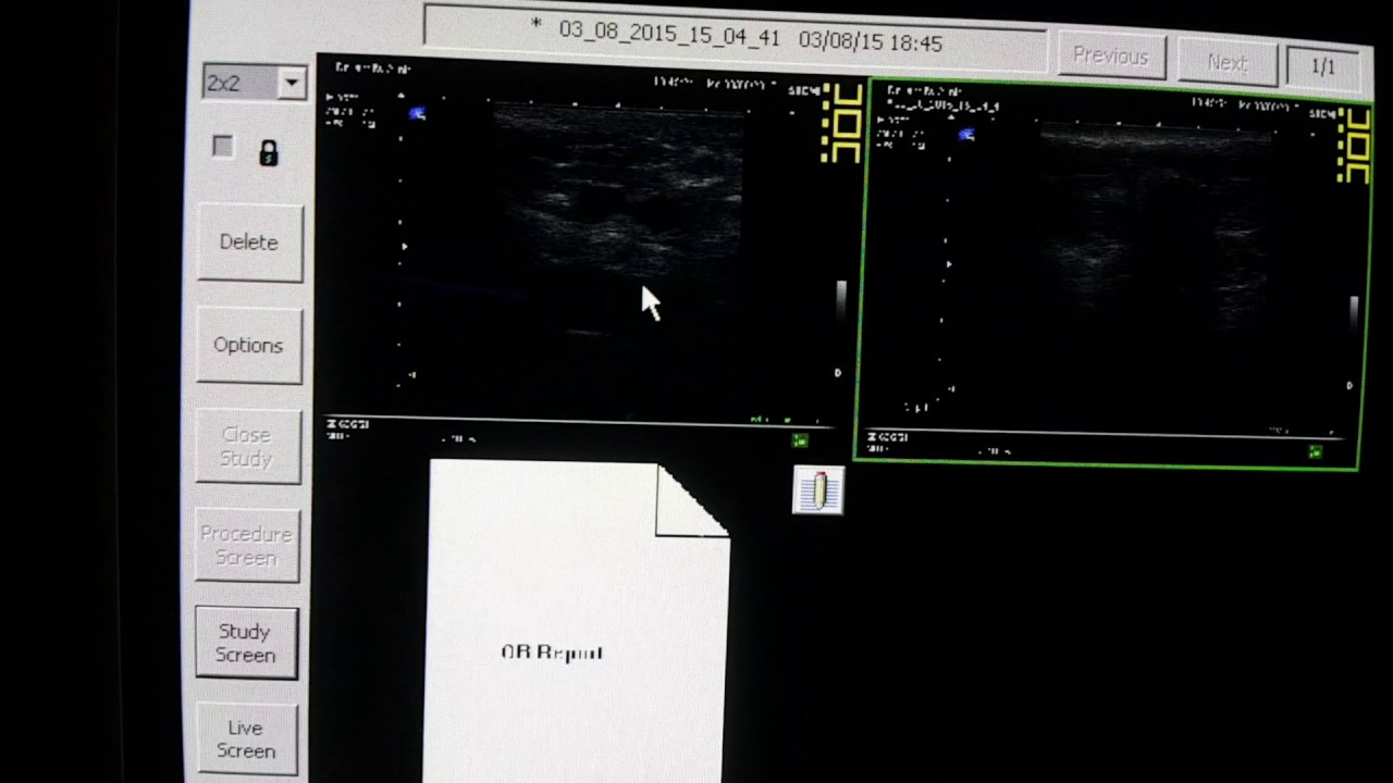 Breast CA with axillary LN Mets Sonography - YouTube