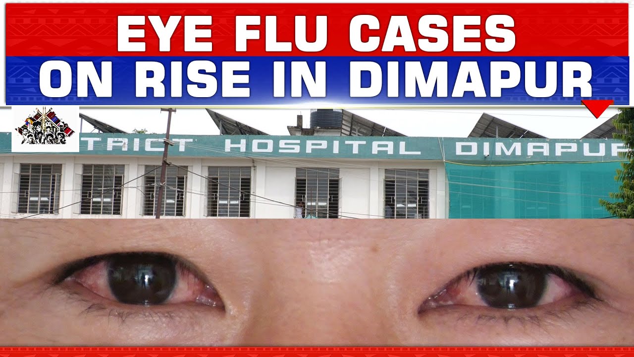 CONJUNCTIVITIS (EYE FLU) CASES ON RISE IN DIMAPUR - YouTube