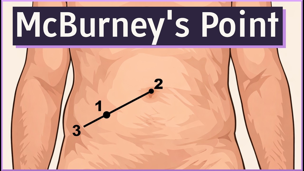McBurney's Point | Appendicitis - YouTube