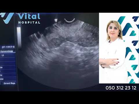 Nadir anomaliya. Anadangəlmə 2 uşaqlıq, 1 böyrəklə yaşayan qadın.  radioloq dr. Günay  050 312 23 12