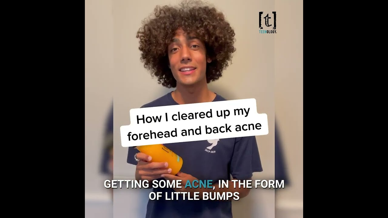 My Forehead and Back Acne Cleared Up with Shampoo and Body Wash from ...