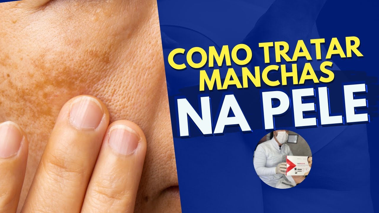 MANCHAS NA PELE - ENTENDA O QUE SÃO DISCROMIAS - YouTube