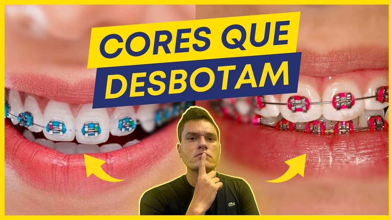 7 CORES DE BORRACHINHAS DO APARELHO QUE DESBOTAM MAIS FÁCIL! - YouTube