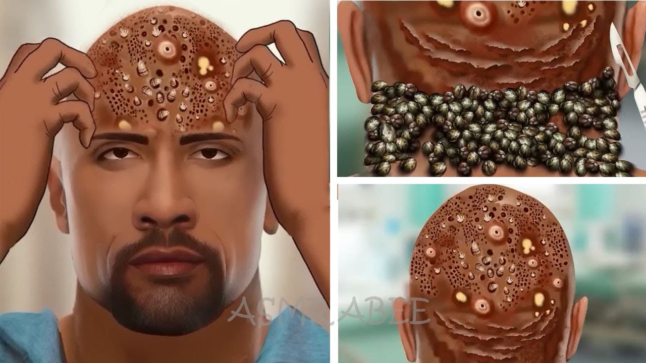 ASMR Cleaning Head Full of Dog Fleas, Disgusting crusts, Pus Hole ...
