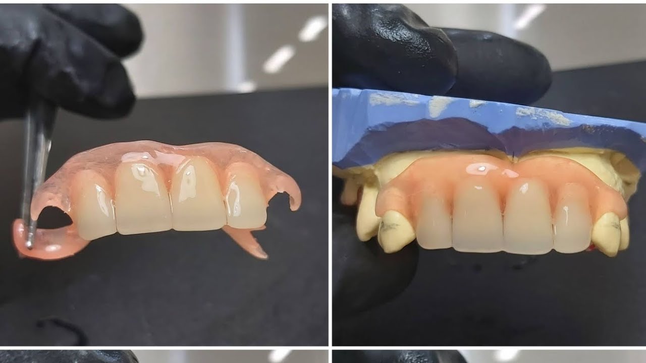 θερμοπλαστικη οδοντοστοιχια κυπρος οδοντοτεχνικο εργαστηρι / flexible ...