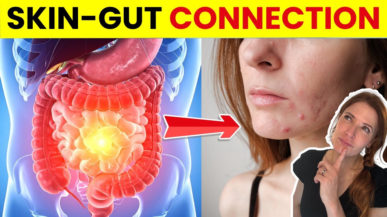 The Gut–Skin Axis Explained: How Your Diet Impacts Acne, Rosacea ...