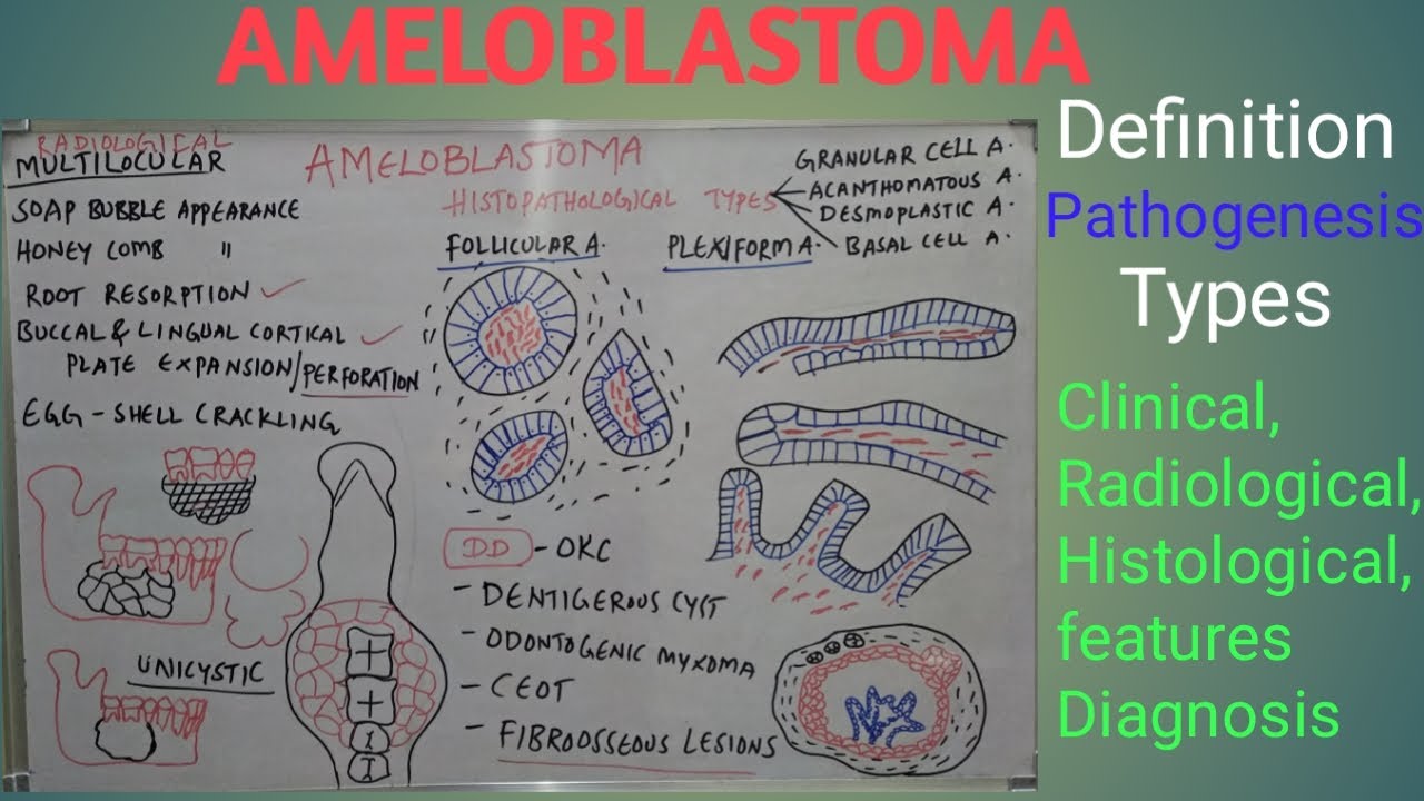 Ameloblastoma - Definition, pathogenesis, types, clinical, radiological ...