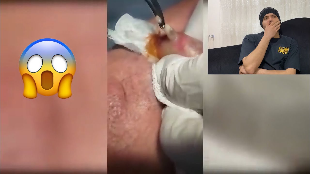 Popping huge blackheads and Giant Pimples- Best Pimple Popping Videos - YouTube