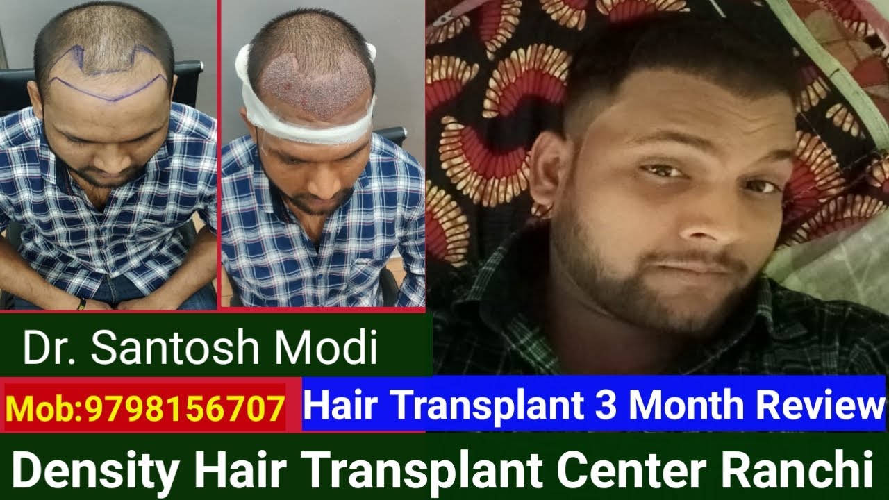 Hair Transplant Result After 3 Months | Density Hair Transplant Ranchi ...