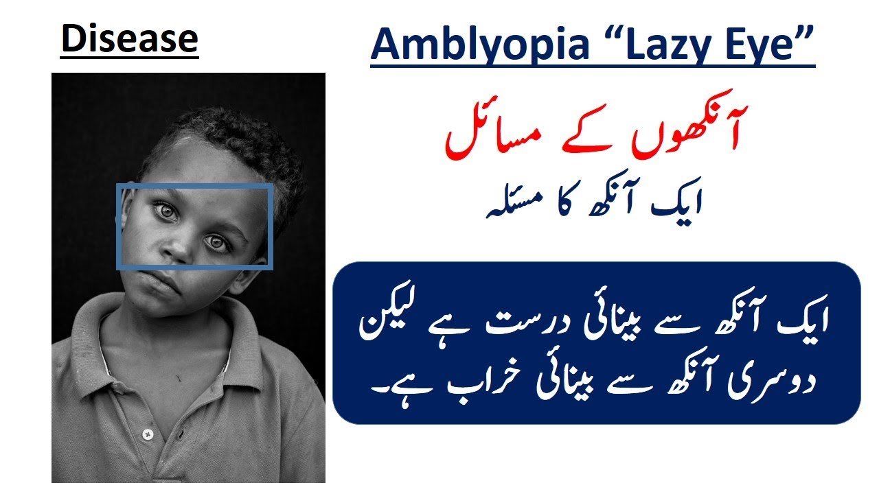 Lazy Eye, (Amblyopia) | One Eye has Dim Vision and other is Ok | Most ...