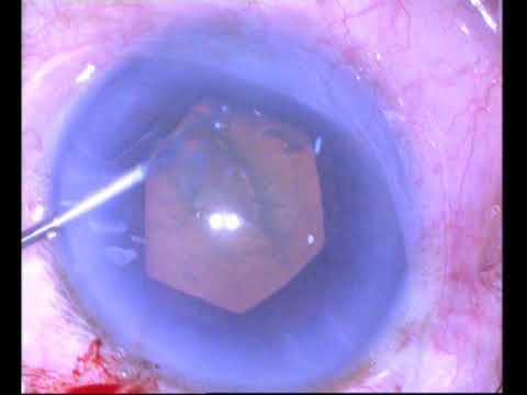 my experience with B -Hex ring - YouTube